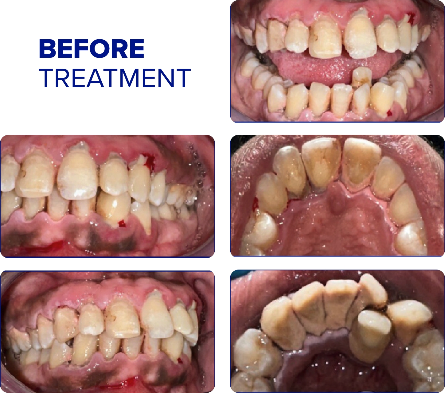 Successful Integration of PerioDT® in a Severe Periodontal Case