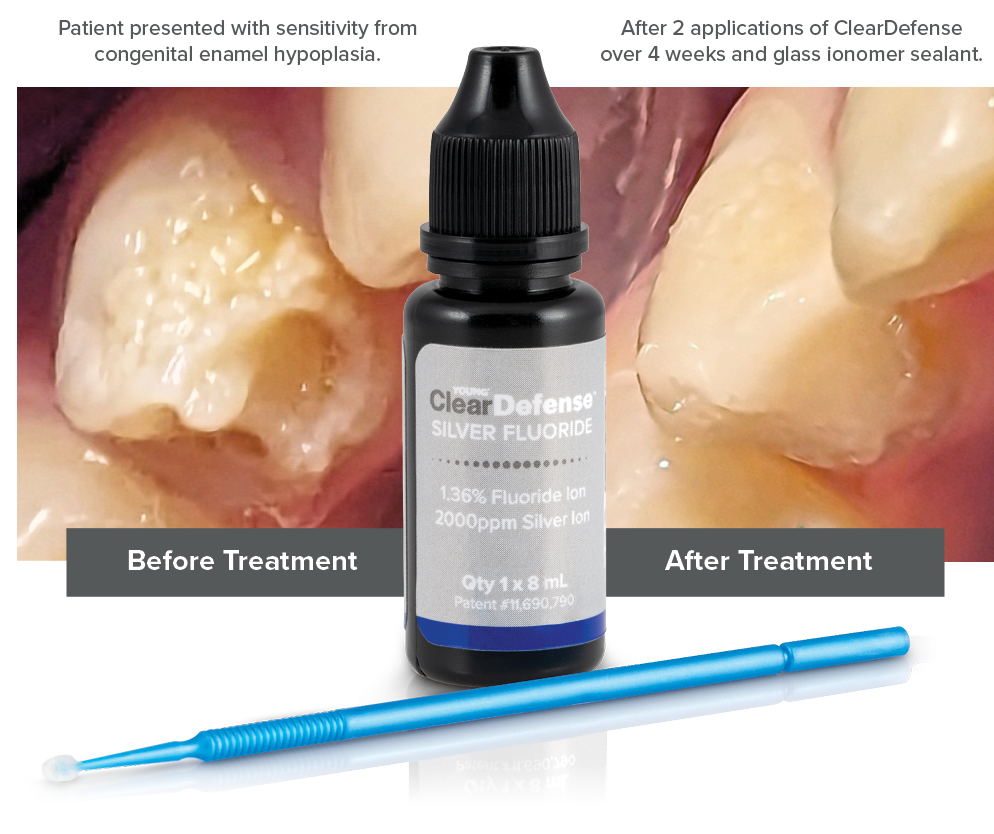 Advanced Solution for Dental Hypersensitivity | Young ClearDefense™ Silver Fluoride