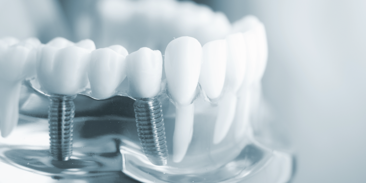 Implants for Dummies: What You Should Know About Implants But Were ...
