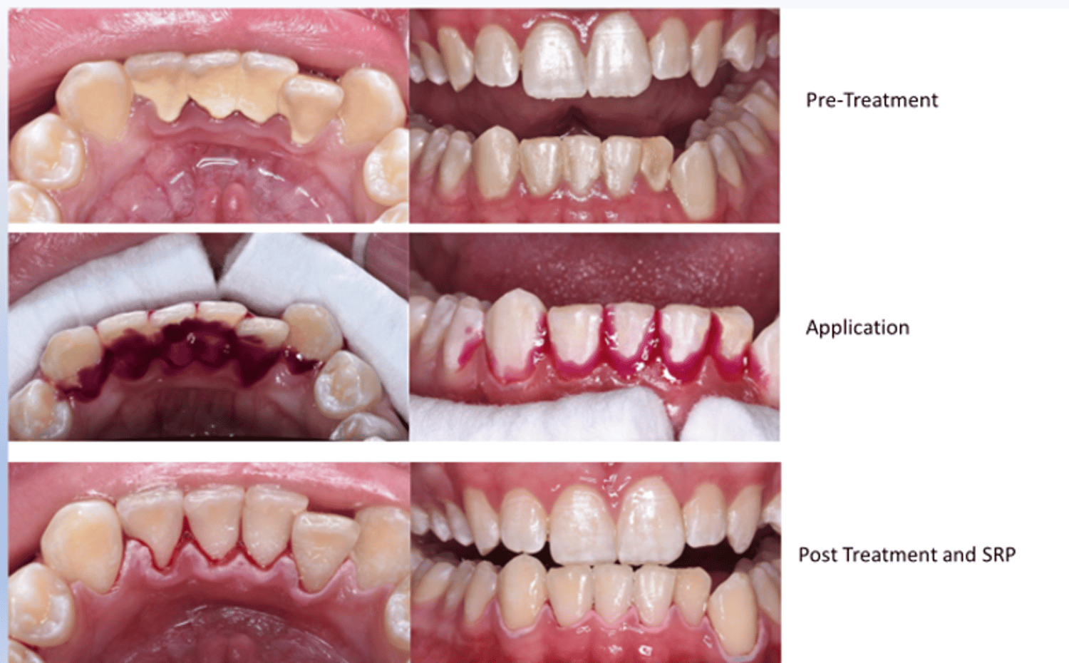 Oral Debridement Agent with Desiccation Technology | PerioDT