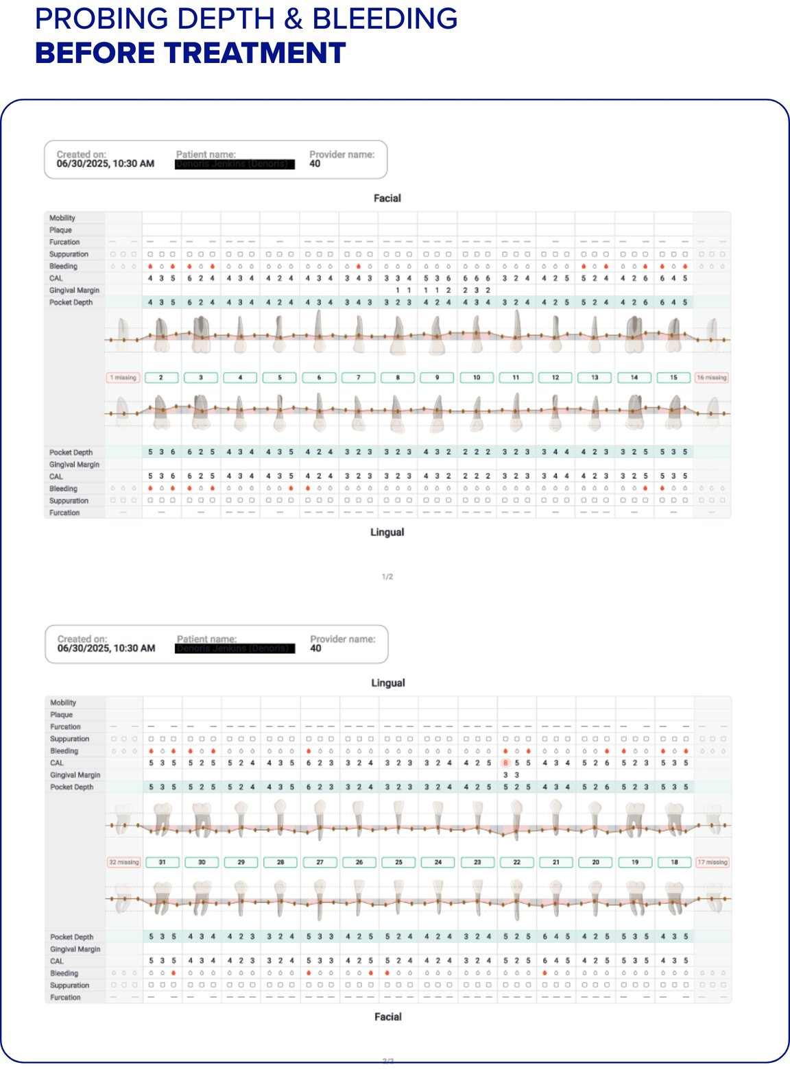 Successful Integration of PerioDT® in a Severe Periodontal Case
