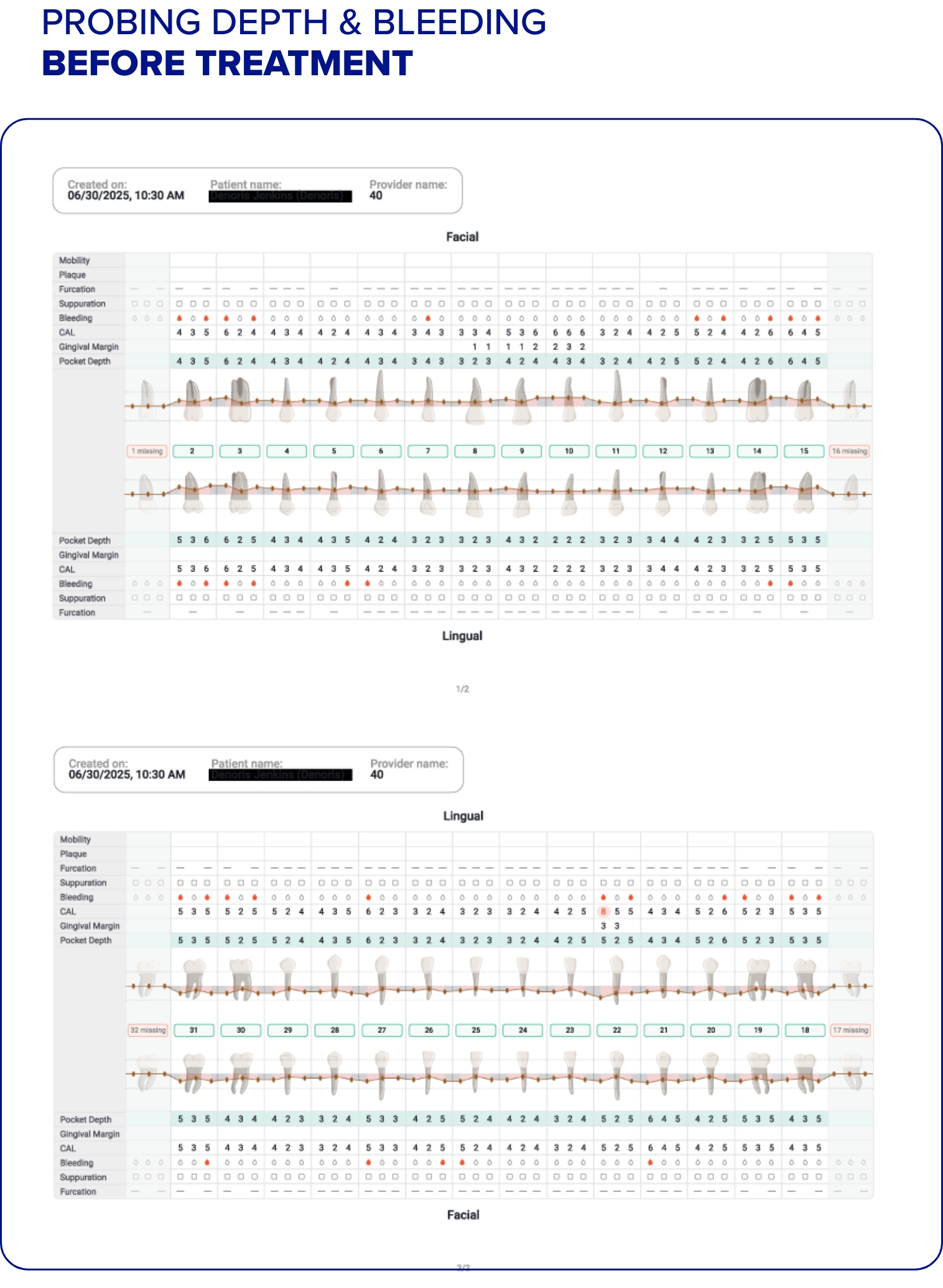 Successful Integration of PerioDT® in a Severe Periodontal Case