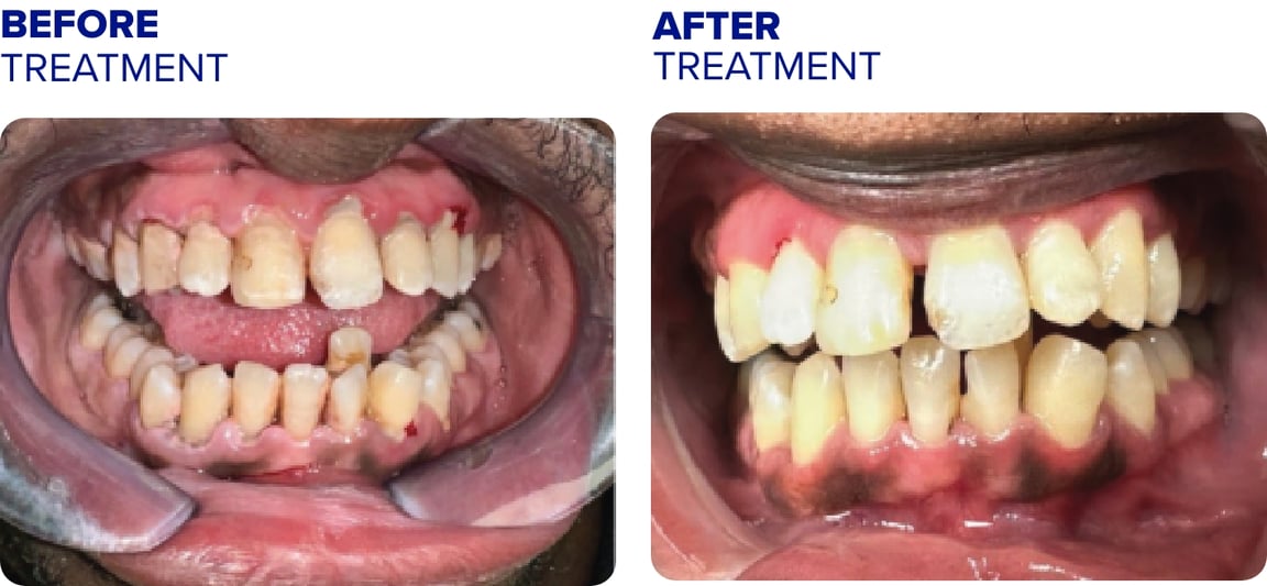 Revolutionizing Severe Periodontal Care: Transformative Results with ...
