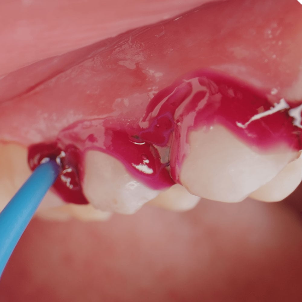 Periodontal Debridement | Desiccate Biofilm in Seconds | PerioDT